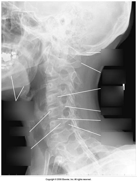 Oblique Cervical Spine Diagram Quizlet