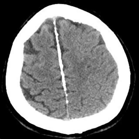 Facial Computed Tomography Scan Axial View Bone Windows Multiple