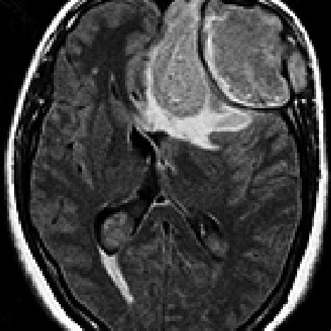 c RM cerebral preoperatoria en DWI Imágenes descritas con apariencia