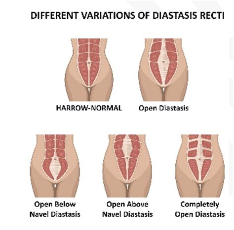 Diastasis Recti
