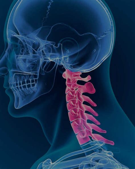 Hérnia de disco cervical Causas Diagnósticos e Tratamentos Dr José