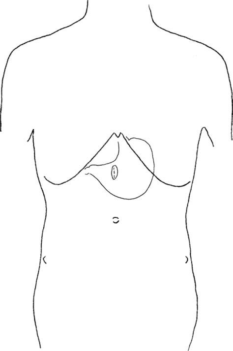 Diagram Lower Abdominal Incision Diagram Mydiagram Online
