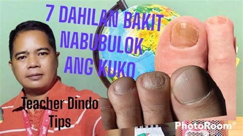 7 DAHILAN BAKIT NABUBULOK ANG KUKO YouTube
