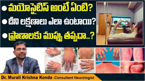 మయపతత మపప తపపద Myositis Disease Symptoms in Telugu