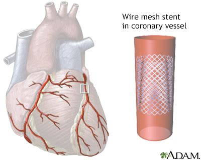 Angioplasty And Stent Placement Peripheral Arteries Discharge