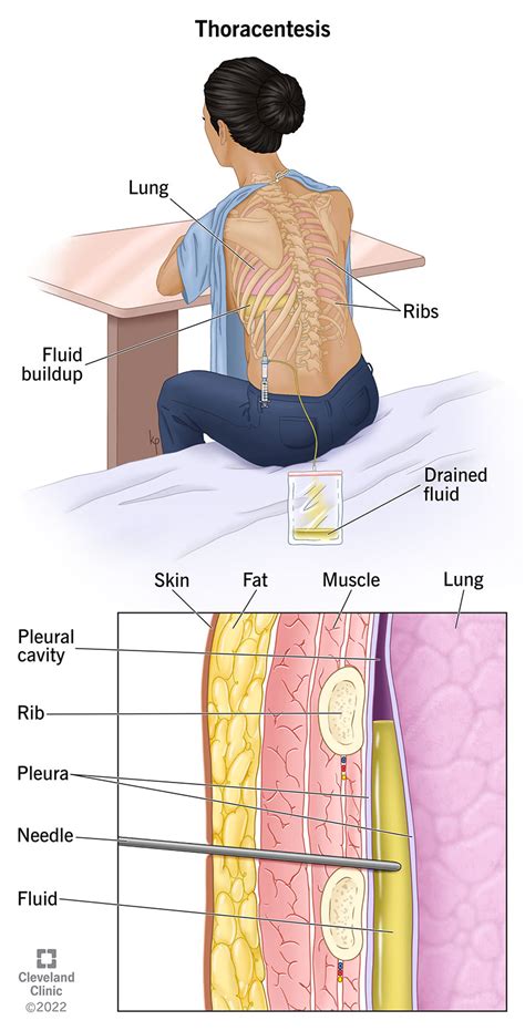 Top How Do Doctors Get Rid Of Fluid On The Lungs