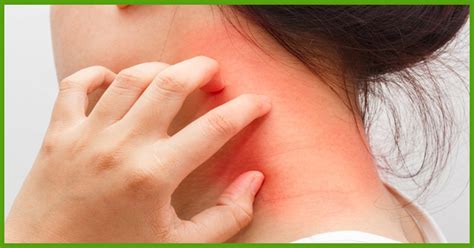 Dermatite Atopica Cause E Rimedi Naturali Verdebenessere