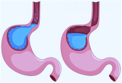 Controla tu reflujo gastroesofágico Síntomas y Tratamiento Logopedia