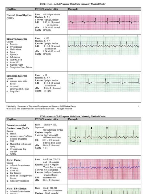 EKG Examples Of Interpretation Ekg Interpretation Cheat Sheets Ekg