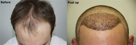 Frontal Region Hair Restoration 3500 FUE Grafts Alvi Armani Hair