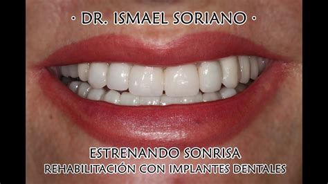 ELEVACIÓN DE SENO REHABILITACIÓN CON IMPLANTES DENTALES DR ISMAEL