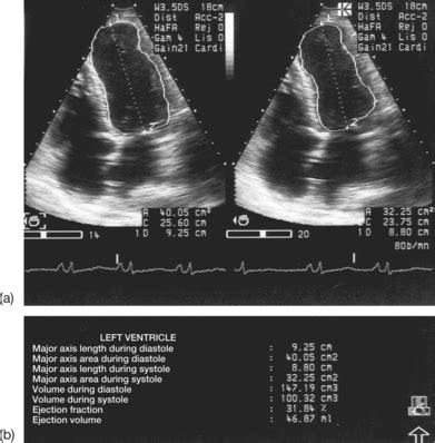 Lv Mass Measurement 2d Echo Semashow
