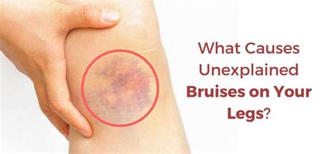 Unexplained Bruising