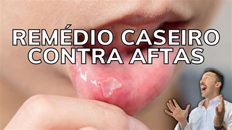 Remédio Caseiro para Aftas RECEITA NA LEGENDA YouTube