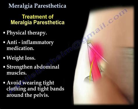 26 Best Meralgia Parasthetica Images On Pinterest