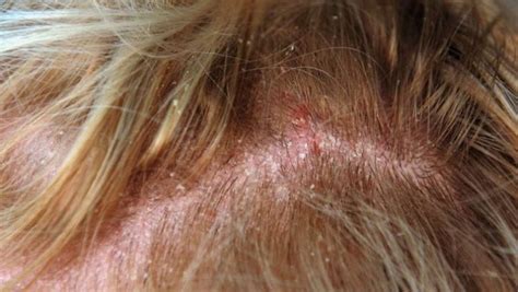 Seborrheic Dermatitis Symptoms Causes Diagnosis Treatment