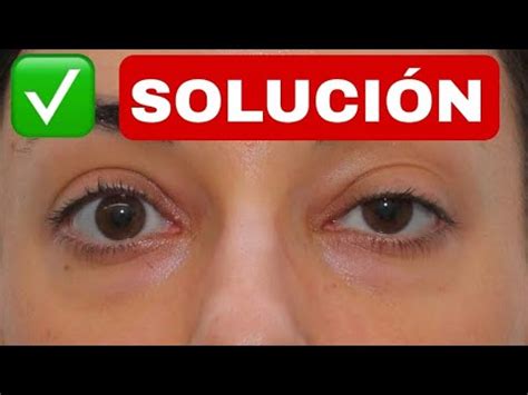 Por qué tengo un ojo más cerrado que otro Descubre la respuesta