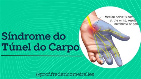 Síndrome do Túnel do Carpo YouTube