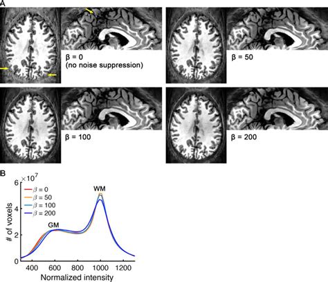 background noise suppression a anatomical mt weighted images were download scientific