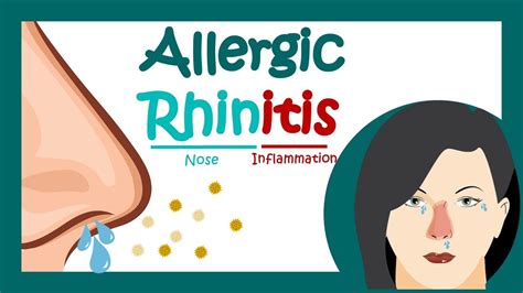 Allergic Rhinitis What Is Allergic Rhinitis What Is The Main Cause