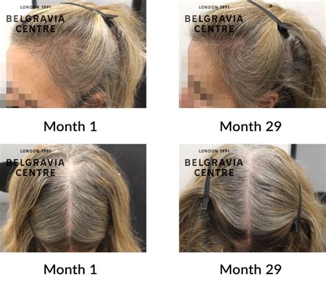 Hair Loss Success Story Wonderful Two Years Of Treatment