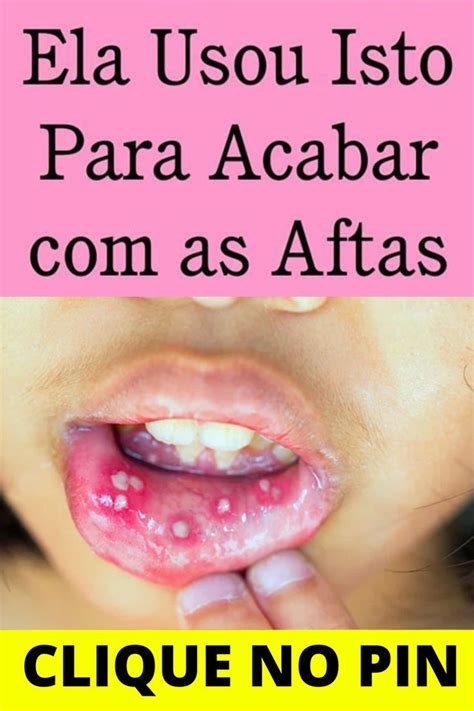 COMO CURAR AFTA NA BOCA RÁPIDO CASEIRO afta Como curar afta Aftas