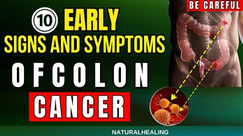 10 Early Warning Signs Of Colon Cancer You Should Not Ignore Colon