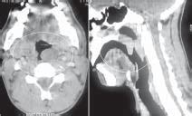Pre Treatment CT Scan Of Neck Axial And Sagittal View White Circle