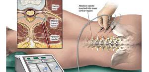 Radiofrequency Ablation Ispine