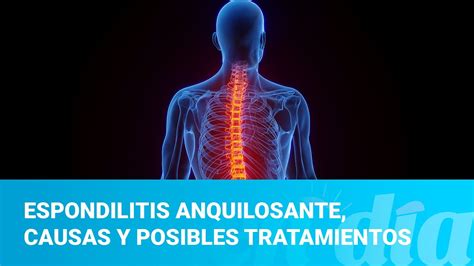 Espondilitis Anquilosante Causas Y Posibles Tratamientos YouTube