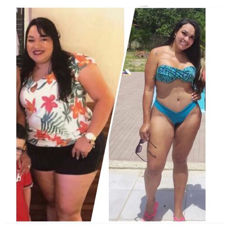 Abdominoplastia lipoaspiração e Mastopexia Próteses de silicone de