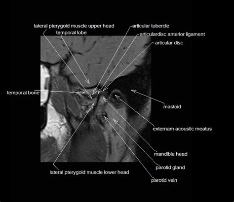 Temporomandibular Joint Anatomy MRI TMJs Anatomy Free Sagittal