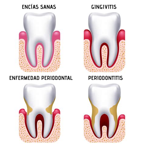 Enfermedad de las encías la periodontitis Clínica EMET