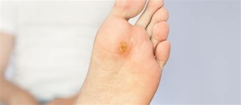 Sabe o que é olho de peixe ou verruga plantar Conheça sinais e