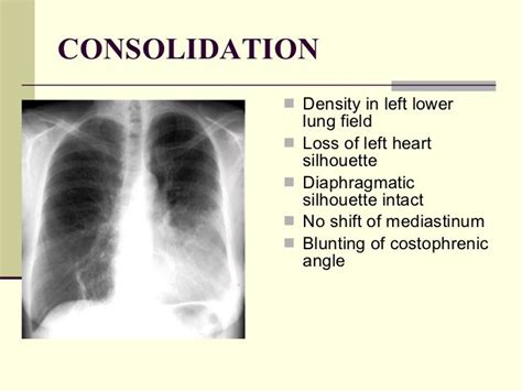 Consolidation Density In Left Lower Lung Field Loss Of Left Heart