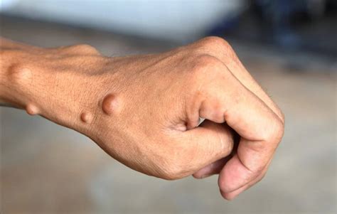 Neurofibromatosis NYSORA