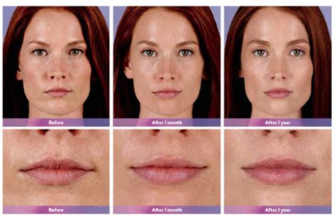 Juvederm Ultra Plus XC Before And After Doylestown Bucks County PA