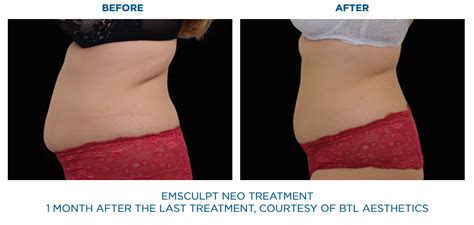 Emsculpt Neo La Chele Medical Aesthetics Llc