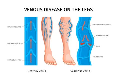 What Do You Understand By Varicose Veins