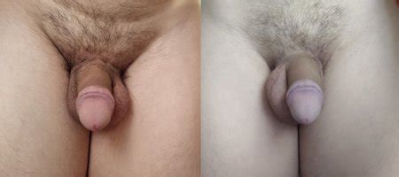 Keeping Foreskin Retracted Page 2 LPSG