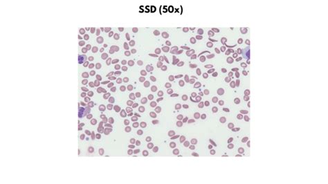 Hemolytic Anemias The Blood Project