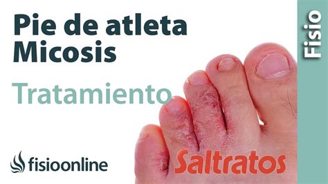 Pie de atleta Hongos o micosis Qué es causas síntomas y