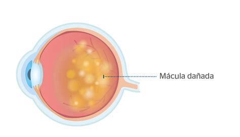 Degeneraci N Macular Mi Pica O Maculopat A Mi Pica Qu Es Blog De