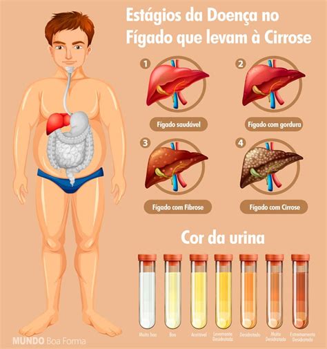 10 principais sintomas de gordura no fígado MundoBoaForma