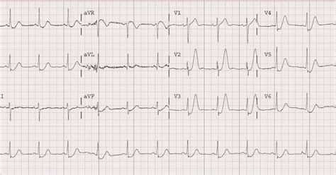 Dr Smith S ECG Blog Hyperacute T Waves