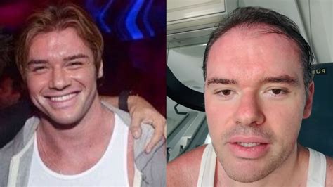 Thor Batista choca internautas após calvície veja antes e depois