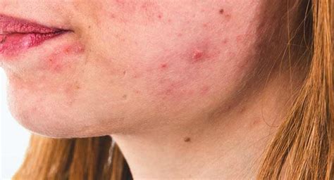 Accutane Birth Defects Years Later