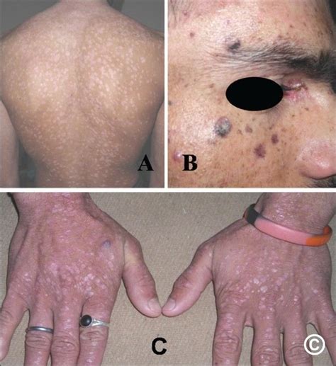Epidermodysplasia Verruciformis