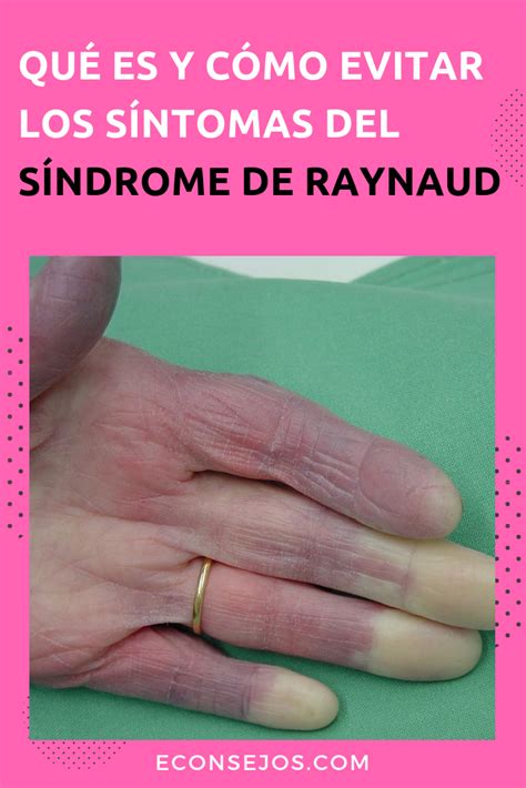 Qué es el síndrome de Raynaud y cómo reducir sus dolores Remedios