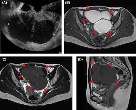 Transvaginal Ultrasound And Magnetic Resonance Imaging Findings A